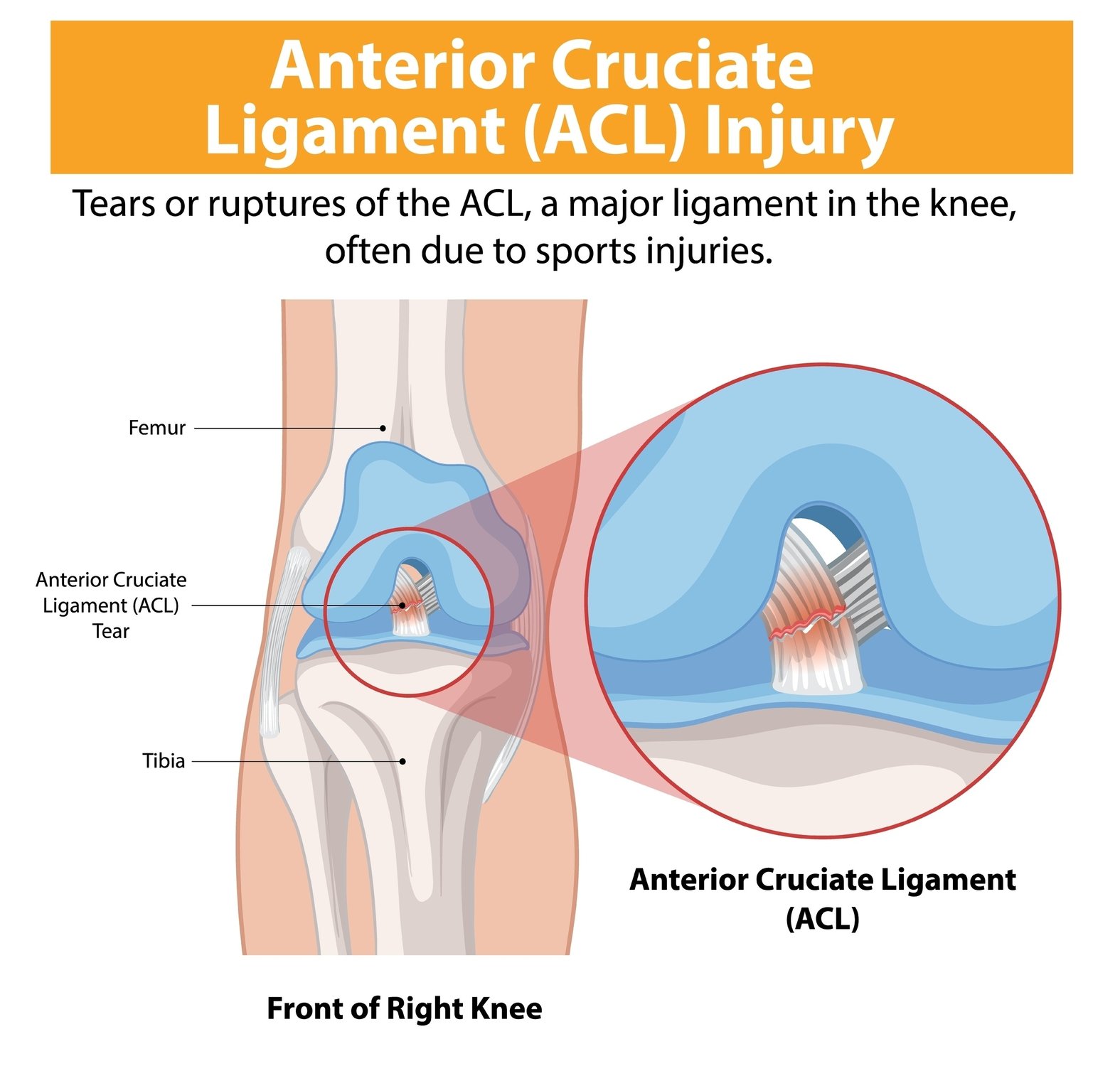 Preventing ACL Injuries: Common Causes and the Role of Physical Therapy