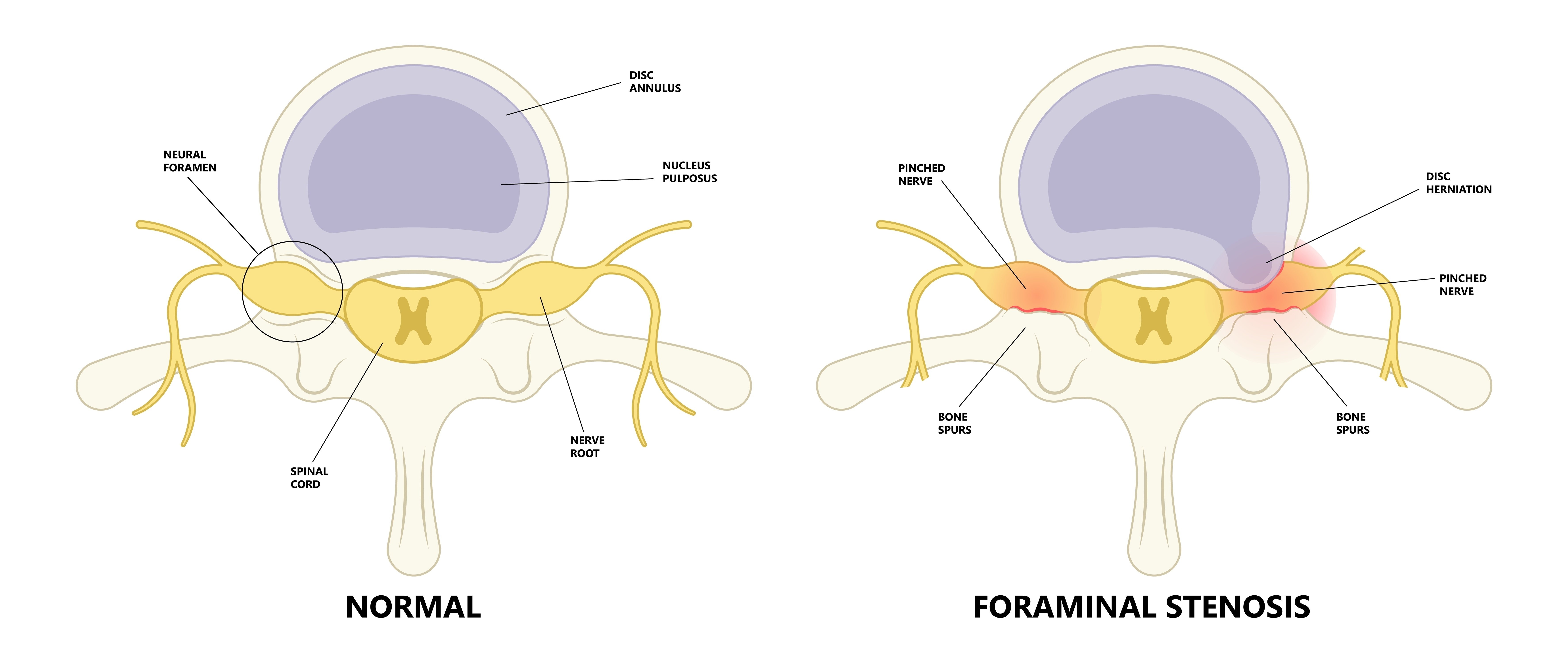Causes of Spinal Nerve Compression