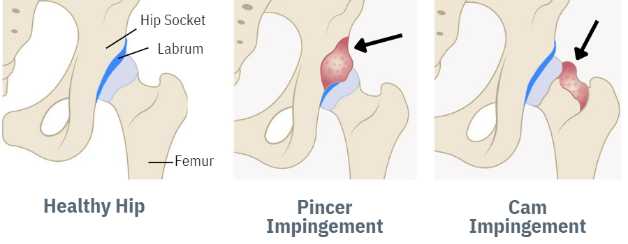 Understanding Hip Impingement: Causes, Symptoms, and Treatment Options