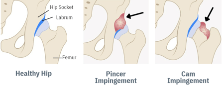 Understanding Hip Impingement: Causes, Symptoms, and Treatment Options