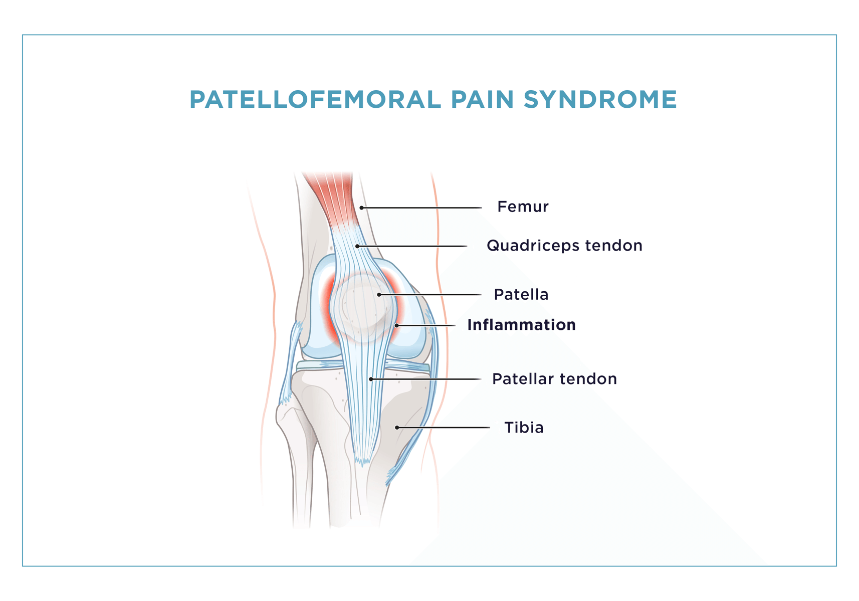 Understanding and Managing Patellofemoral Pain Syndrome (PFPS)