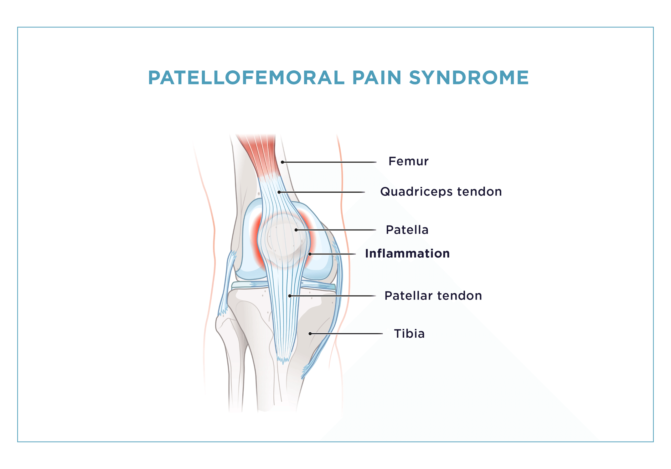 Understanding and Managing Patellofemoral Pain Syndrome (PFPS)