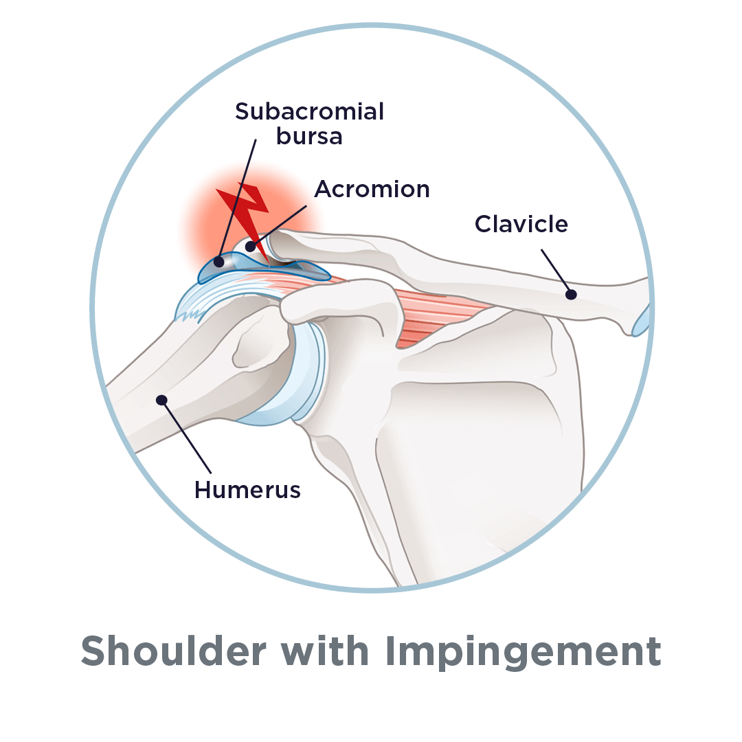 Understanding Shoulder Impingement: Causes, Symptoms, and Treatment