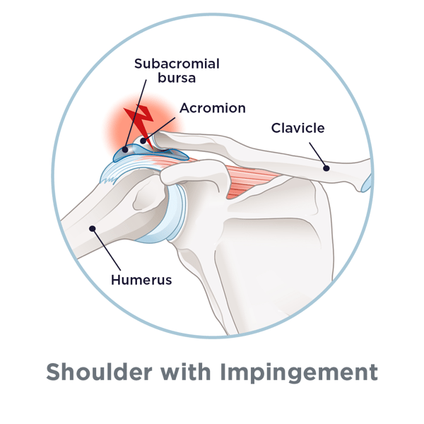 Understanding Shoulder Impingement Causes Symptoms And Treatment