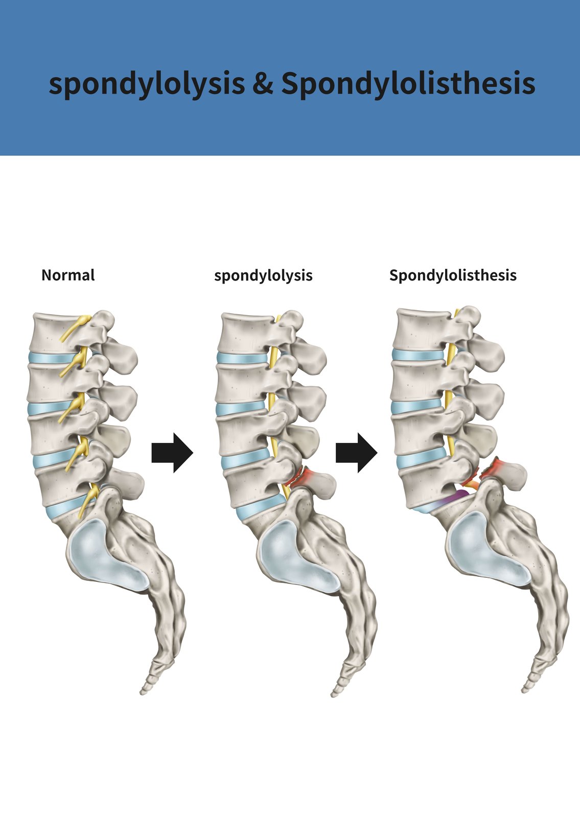 What Is Spondylolisthesis, And How Can Physical Therapy Help?