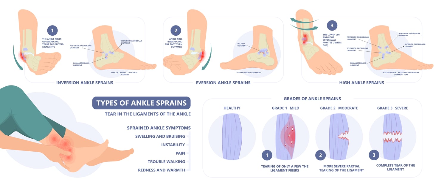 Understanding Ankle Injuries: Causes, Severity, and Treatment Plans
